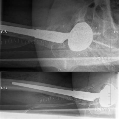 Case 5 Revision For Implant Wear Of The Polyethylene Liner With Very