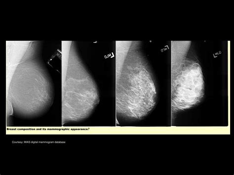 ppt digital mammography powerpoint presentation free download id
