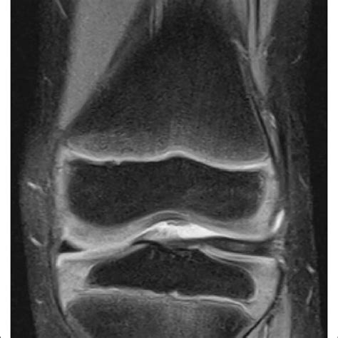 T2 Weighted Mri Demonstrating Lateral Discoid Meniscus In Coronal
