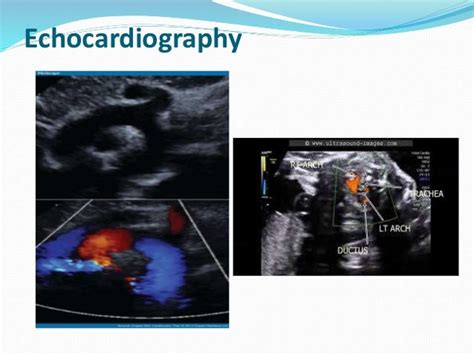 Vascular Ring And Sling