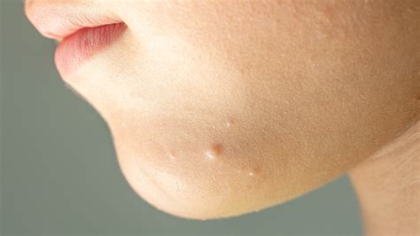 Novans Berdazimer Gel Could Be Effective Molluscum Treatment