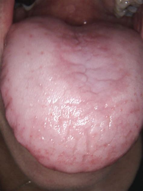 Pernicious Anemia Glossitis Exhibiting A Red Smooth Appearance And Download Scientific