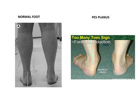 Pes Planus Ppt
