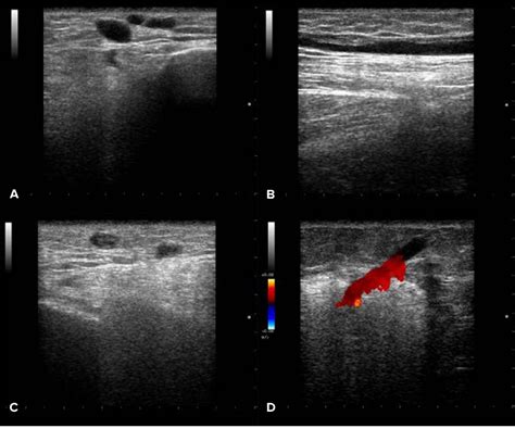 Figure 3 From Severity Stratification By Compression Ultrasound