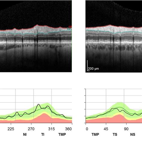 Oct Retinal Nerve Fibre Layer Rnfl Analysis Confirming Mild