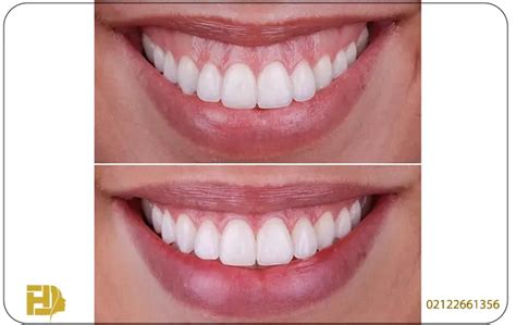 روش‌های درمان لبخند لثه ای معرفی انواع لبخند لثه‌ای اسمایلی گام