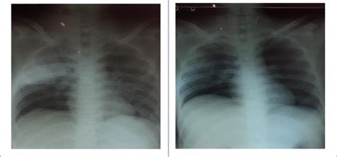 Chest Xray Right Upper Lobe Consolidation Left Complete Resolution