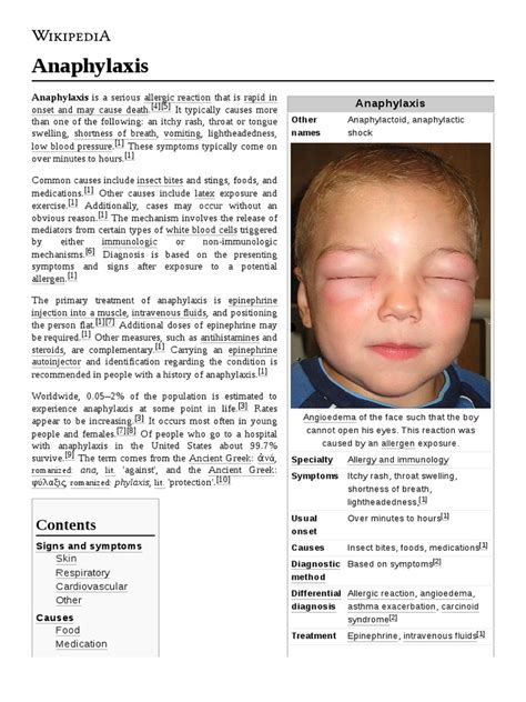 Anaphylaxis Swelling