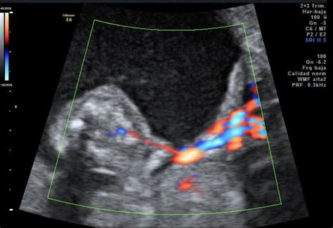Fetus In Fetu Prenatal And Postnatal Images American Journal Of