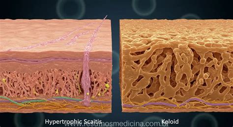 Queloides Vs Cicatrizes Hipertróficas Guia Completo Para Diferenciar