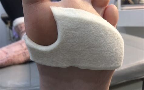 How To Treat Sesamoiditis Podiatry Faqs