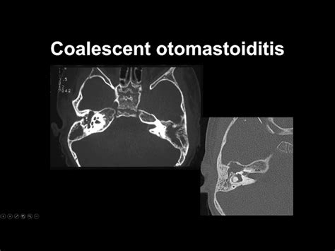 Mastoiditis Mri