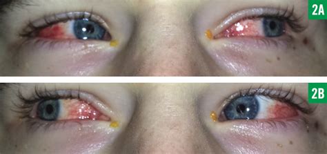 A Case Of Mycoplasma Pneumoniae Associated Mucositis Consultant360