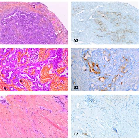 Anatomopathological Examination Of Primary And Peritoneal Lesions Of