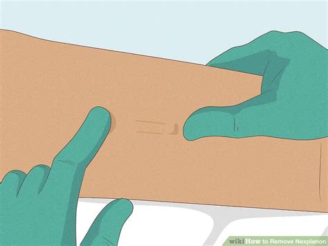 How To Remove Nexplanon Where To Get It Removed And More