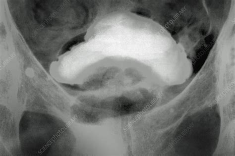Prostate Cancer X Ray Stock Image C0306774 Science Photo Library