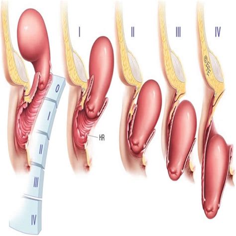 Rectal Prolapse Nisantaşı İstanbul Turkey