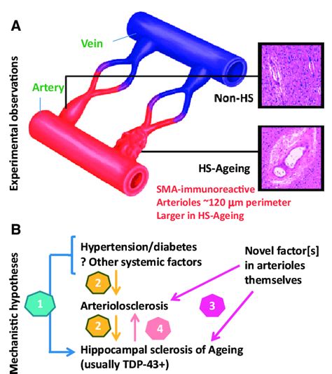 Model Of The Potential Relationships Between Arteriolosclerosis And