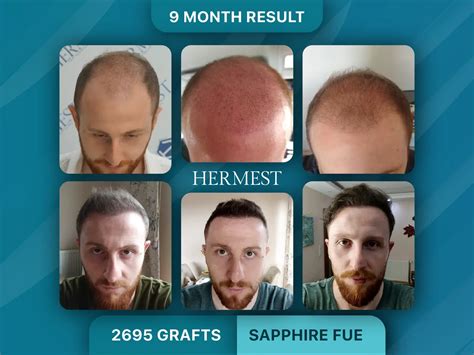 2000 Grafts Hair Transplant Cost Coverage And Timeline