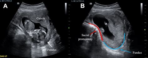 Incarcerated Gravid Uterus In A Nulliparous Female Presenting With