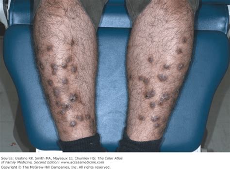 Genodermatoses Basicmedical Key