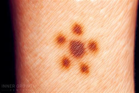 What Are Starseed Birthmarks And How To Identify Them