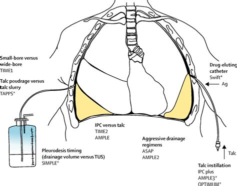 Pleural Effusion Treatment