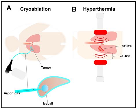 Cutting Edge Therapies For Lung Cancer