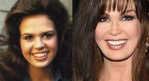 Marie Osmond Plastic Surgery Before And After Pictures Comparison
