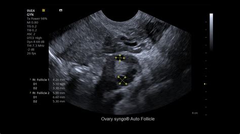 Acuson Maple Is A High Performance Shared Service Ultrasound System Siemens Healthineers