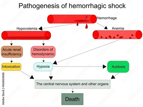 Schematic Pathogenesis Of Hemorrhagic Shock Stock Vector Adobe Stock