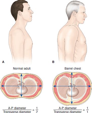 Barrel Chest Copd Emphysema