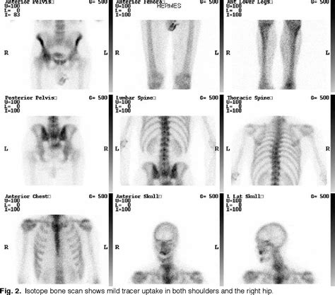 Linea Aspera Semantic Scholar