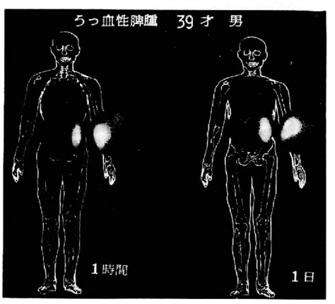 Figure 2 From Thrombokinetics With In 111 Oxine Labelled Platelets
