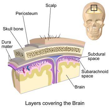 Subdural Hematoma Causes Symptoms And Treatment