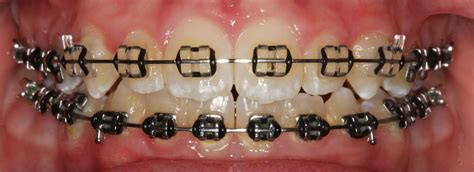 What Are Power Chains For Braces