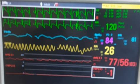 Fetal Complete Heart Block A Successful Surgical Permanent Pacemaker Implantation In A Small
