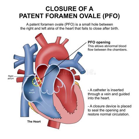 Foramen Ovale Stock Illustrations 18 Foramen Ovale Stock