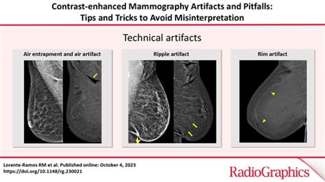 Contrast Enhanced Mammography Artifacts And Pitfalls Tips And Tricks