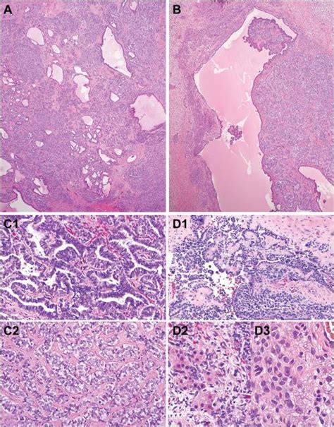 Testicular Neoplasms With Sex Cord And Stromal Components Harbor A