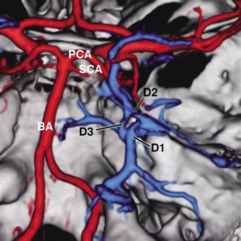 Three Dimensional Computed Tomography Angiogram Showing The Vessels