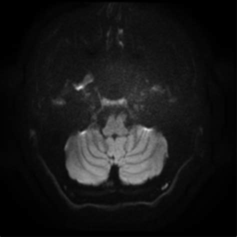 Cerebral Abscess Radiopaedia 57774 64740 Axial Dwi Nc Commons