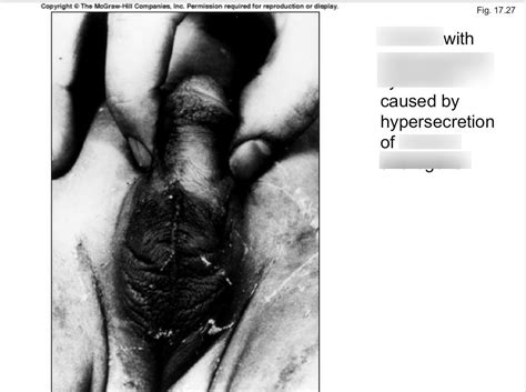 Adrenogenital Syndrome Diagram Quizlet