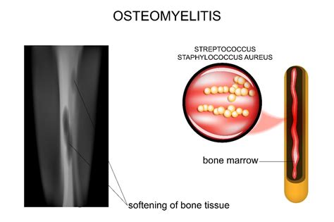 Osteomyelitis Is A Bacterial Infection From Staphylococcus Aureus