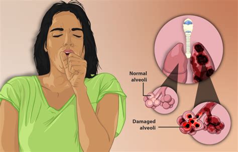 वातस्फीति एम्फिसीमा Emphysema की बीमारी क्या है हो जाने पर इलाज