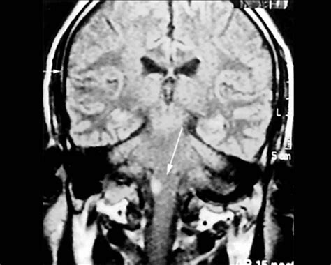 Ffs Lateral Medullary Syndrome • Litfl • Ffs