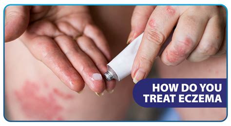 Mild Eczema