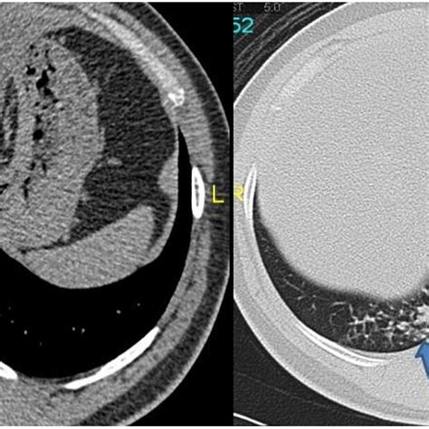 Ct Of The Chest Showing Peripheral Soft Tissue Density Along The