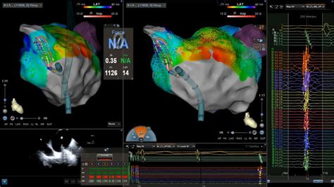Optrell™ Mapping Catheter With Trueref™ Technology Biosense Webster