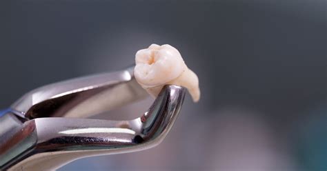Wisdom Tooth Removal Post Op Instructions Atlas Dental
